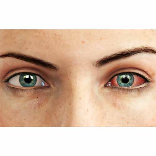 Preventing sore eyes: Good hygiene can help stop the spread of virus ...