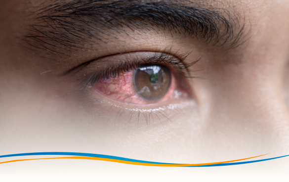 Conjunctivitis & Pink Eye Treatment | Philippines