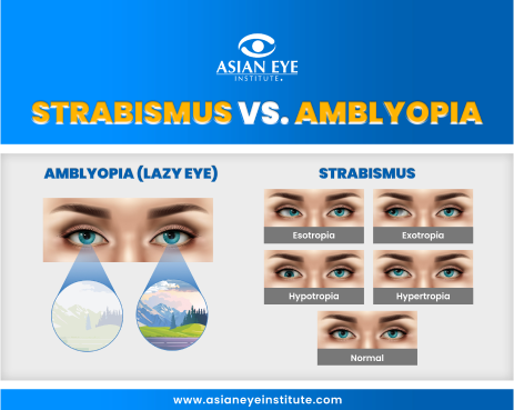 Pediatric & Adult Strabismus Surgery Philippines